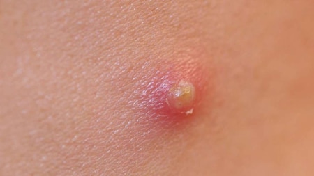 Skin problem: What are the 6 different types of acne?