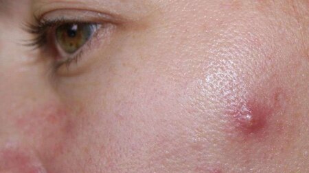 Skin problem: What are the 6 different types of acne?