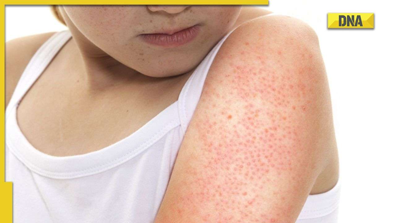 Why does Keratosis pilaris get worse in winter? Home remedies to treat it