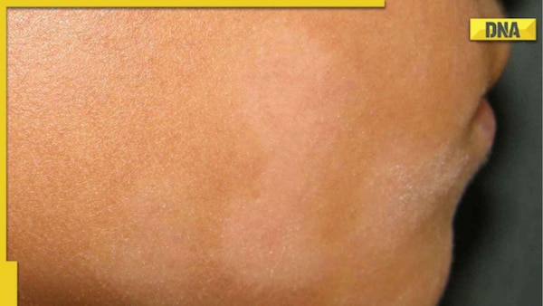 Vitamin deficiencies linked to 'white spots' on face: All you need to know