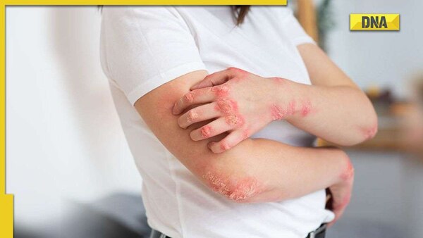 5 natural ways to cure fungal infections of the skin