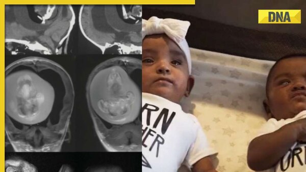 Unbelievable but true! Unborn twin found in one-year-old baby's brain ...