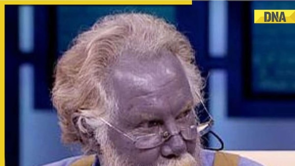 What is argyria, a condition that turns skin colour to blue?