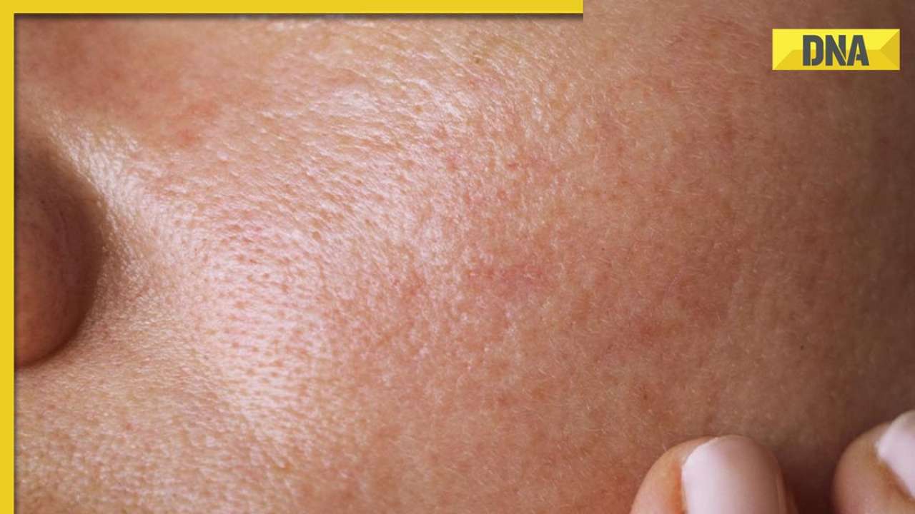 Reasons why your face may be producing excessive oil