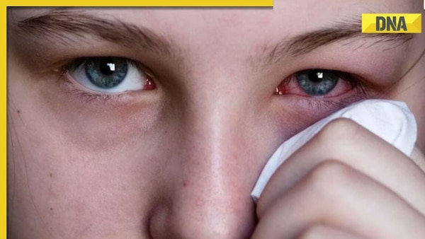 DNA Special: How eye flu cases are increasing in India, know its causes ...