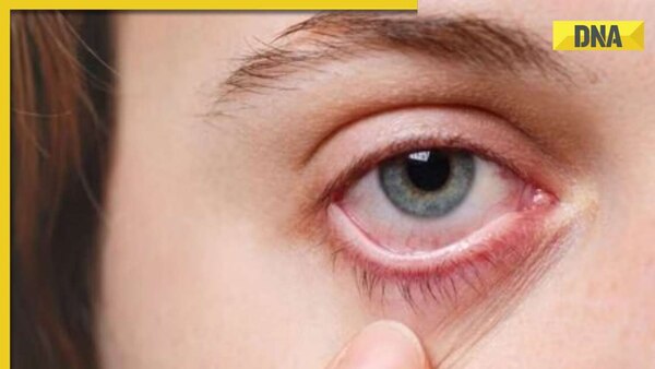Conjunctivitis cases rise in Delhi-NCR: How does pink eye spread ...