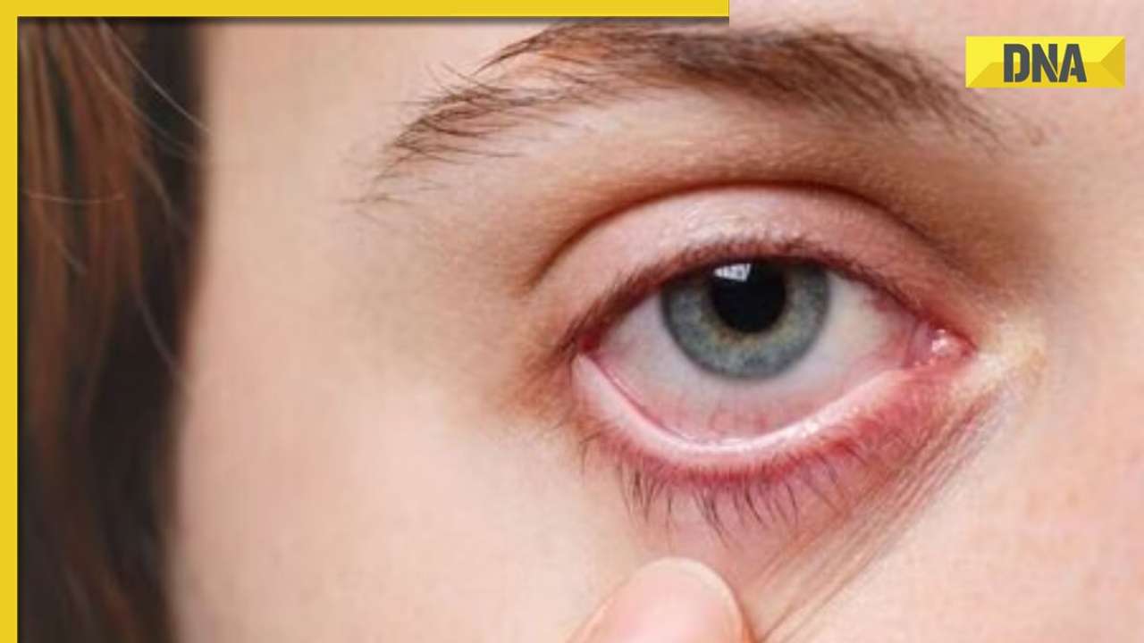 Conjunctivitis cases rise in Delhi-NCR: How does pink eye spread ... Conjunctivitis cases rise in Delhi-NCR: How does pink eye spread ...