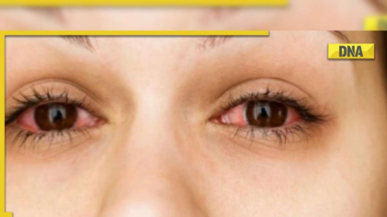 Eye flu: How to identify which kind of conjunctivitis you have? Know ...