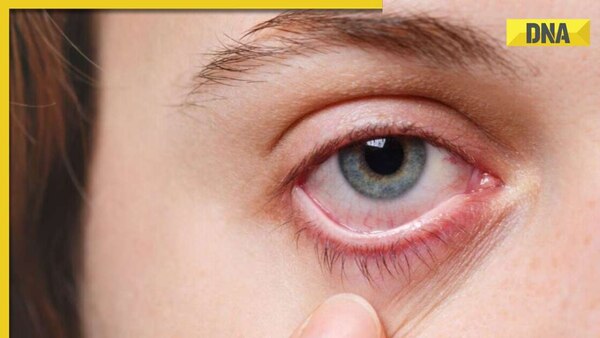 Eye Flu in India: All you need to know about these 5 types of ...