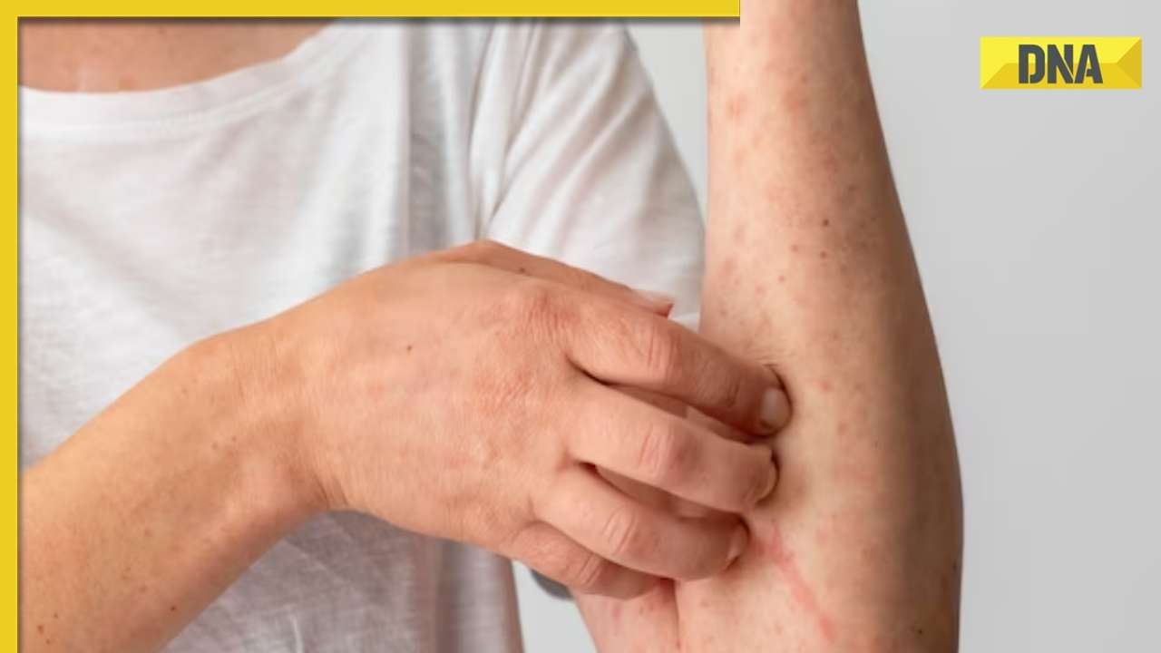New chickenpox variant found in India: Know Clade 9 symptoms ...