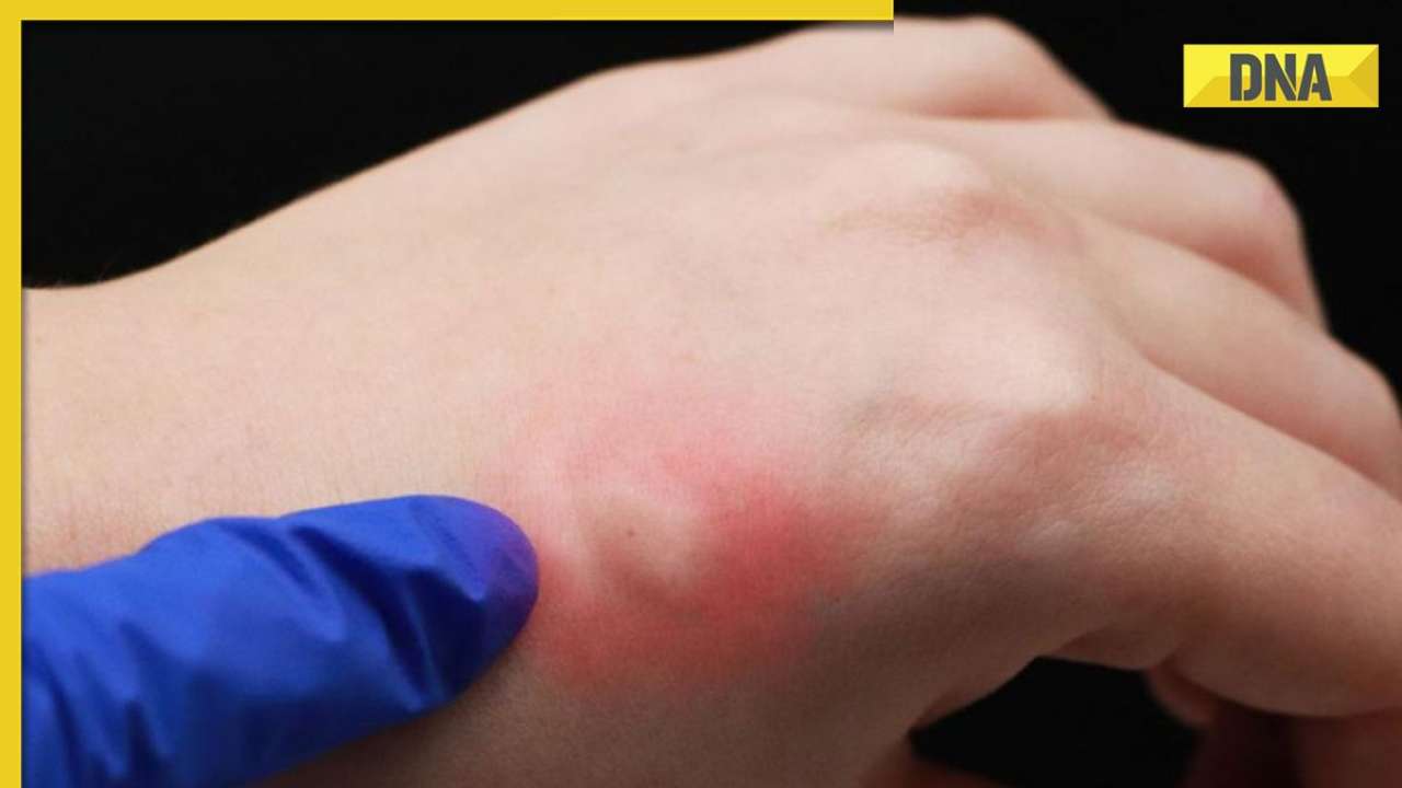 What is skeeter syndrome? All you need to know about the mosquito bite ...