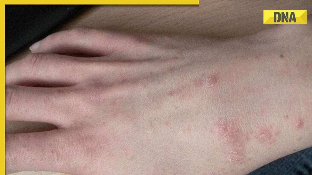 What is scabies, and how to treat this skin infection naturally?