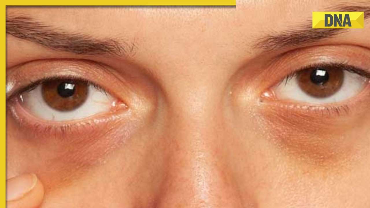 Dark circles: 5 home remedies to treat under eye pigmentation