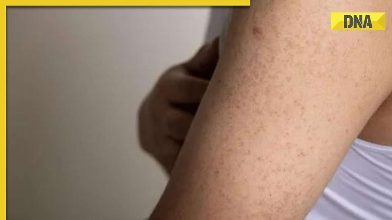 Worried about chicken skin in winter season? Follow these tips to treat it