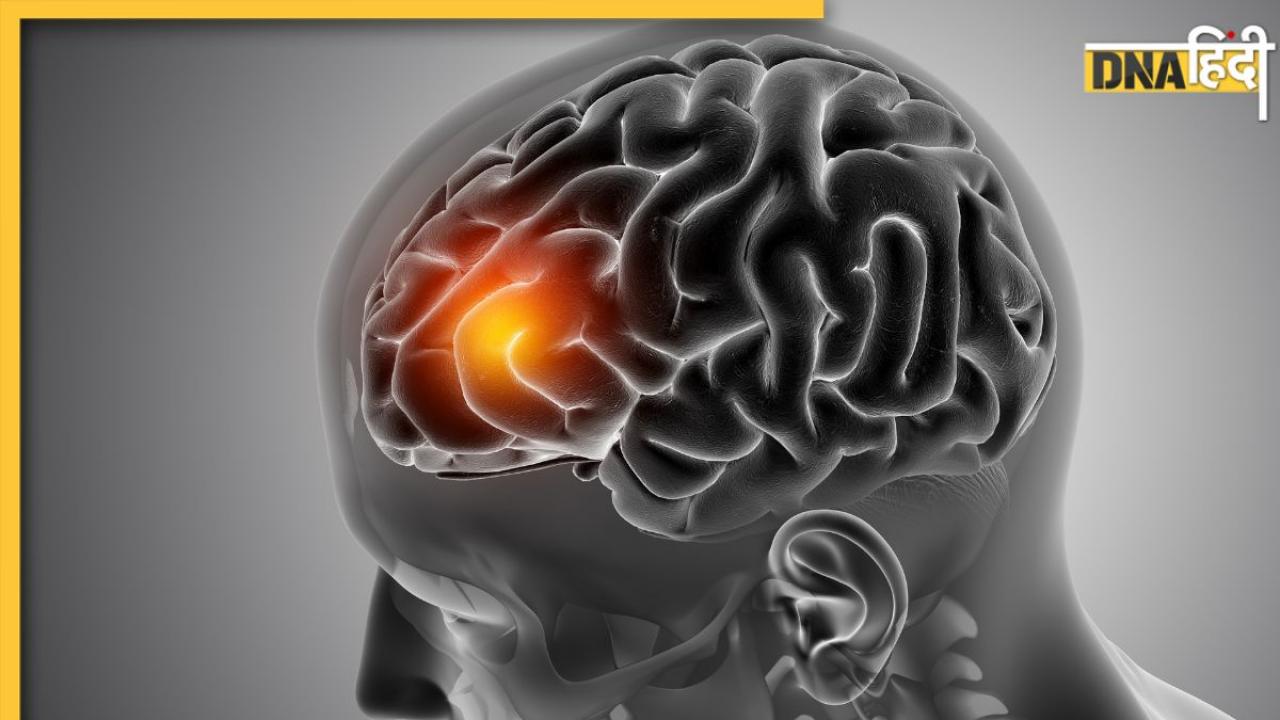 Warning Signs of Brain Stroke: स्ट्रोक आने से पहले नजर आते हैं ये 5 ...