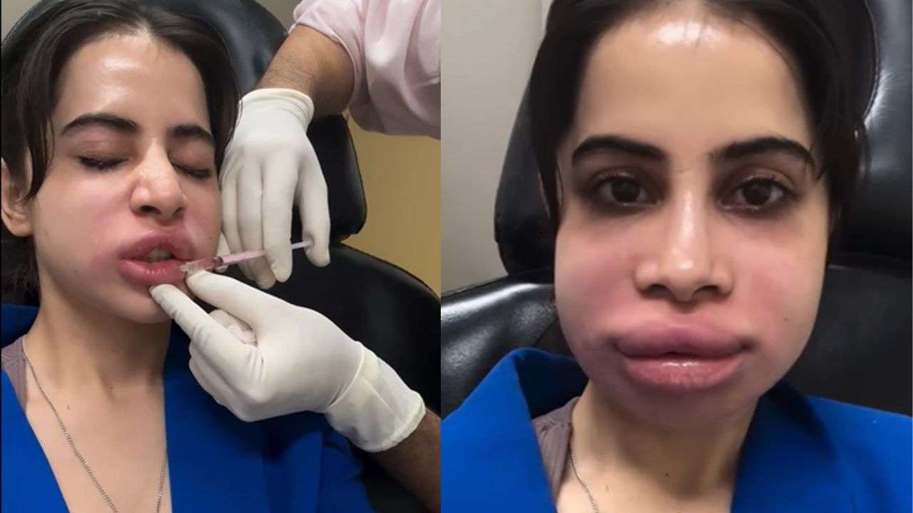 Urfi Javed's lip filler goes wrong, here's what should you know before ...