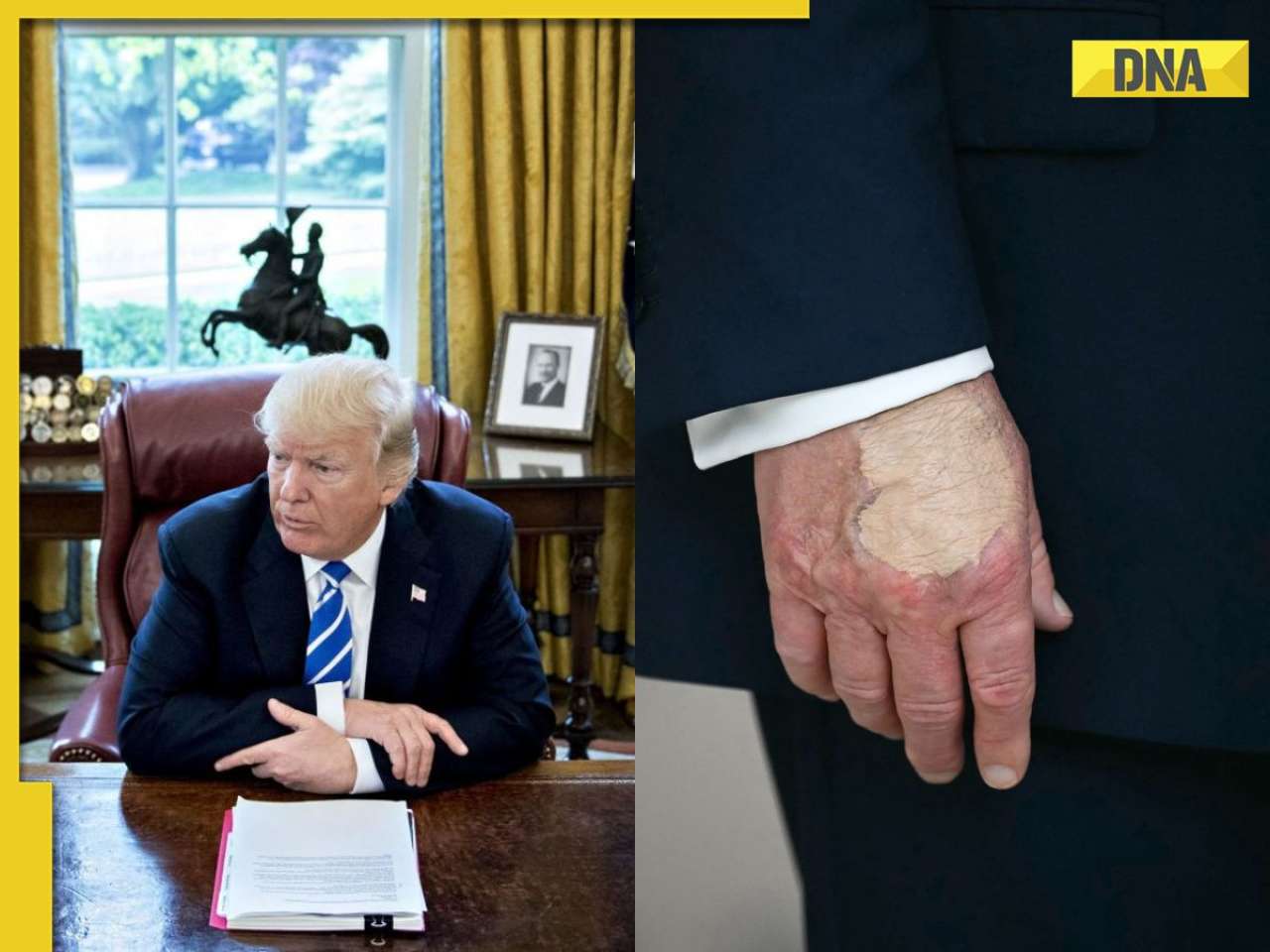 Is Donald Trump’s health deteriorating? Viral photo shows big patch in ...