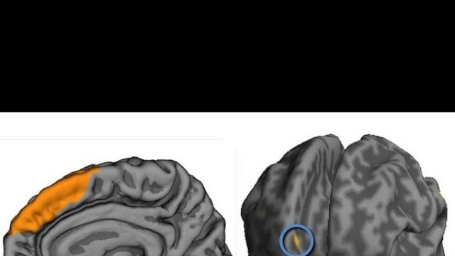 Hallucinations linked to differences in brain structure, finds new study