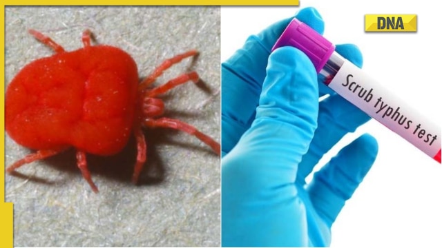 What is scrub typhus disease that took two lives in Kerala? Causes ...