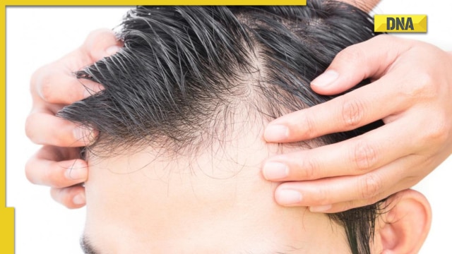Male pattern baldness: Know its causes and treatment