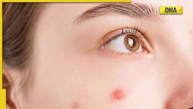 Skincare: know the difference between acne and pimples