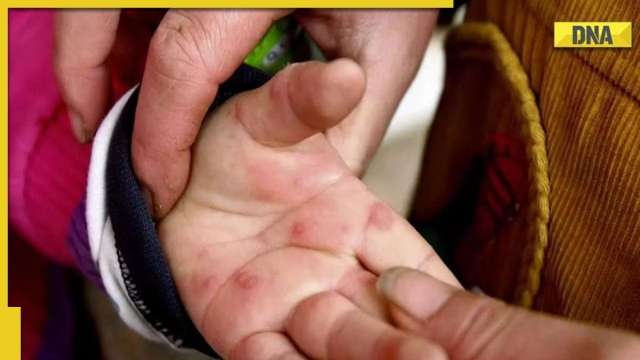 Hand, foot and mouth disease: What to do if your child develops symptoms