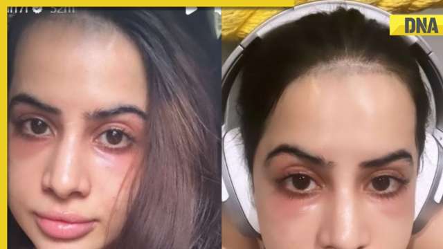 'My face looks f**ked up': Urfi Javed gets under eye-fillers after ...